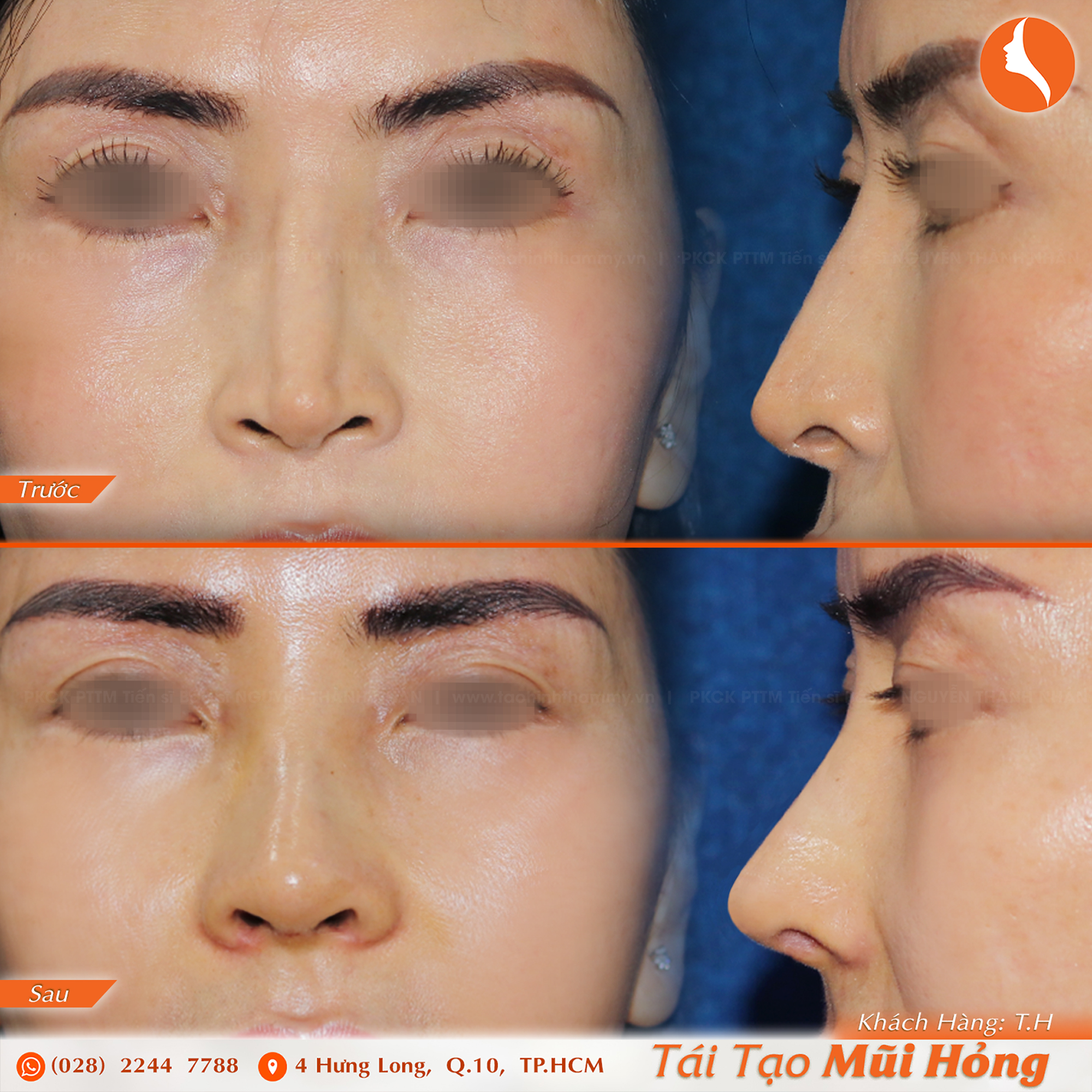 Sửa mũi hỏng sau phẫu thuật - Tiến sĩ Bác sĩ Nguyễn Thành Nhân 20 năm PTTM