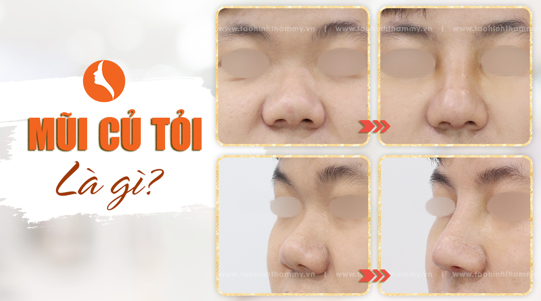 Mũi củ tỏi là gì? Phương pháp nâng mũi cho dáng mũi củ tỏi - Ts. Bs ...