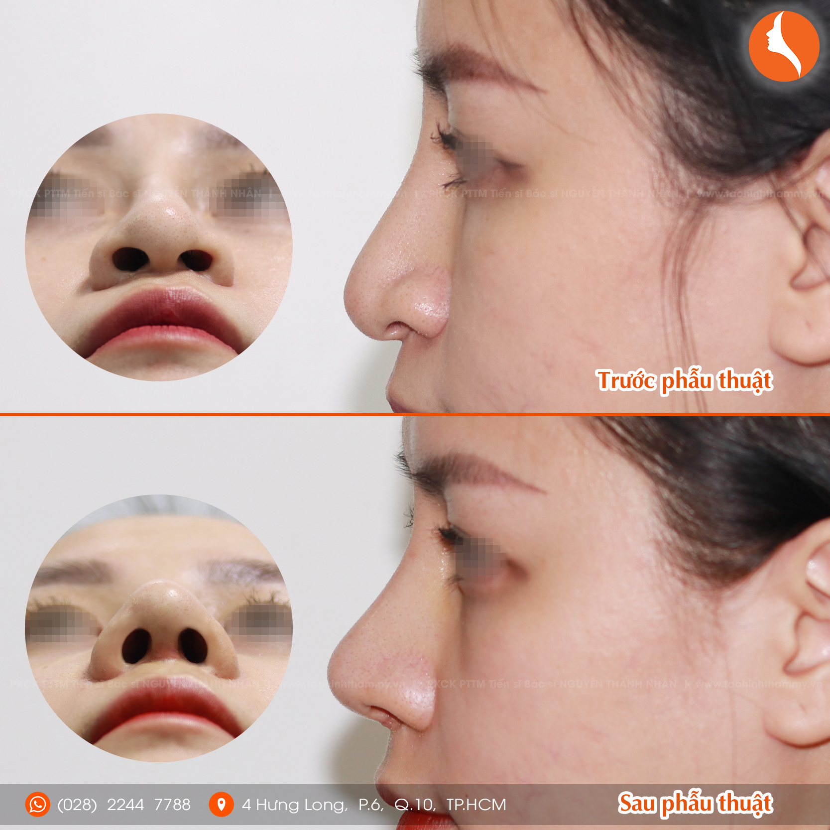 Lỗ mũi hạt chanh là như thế nào? Cách để sở hữu lỗ mũi hạt chanh đẹp ...