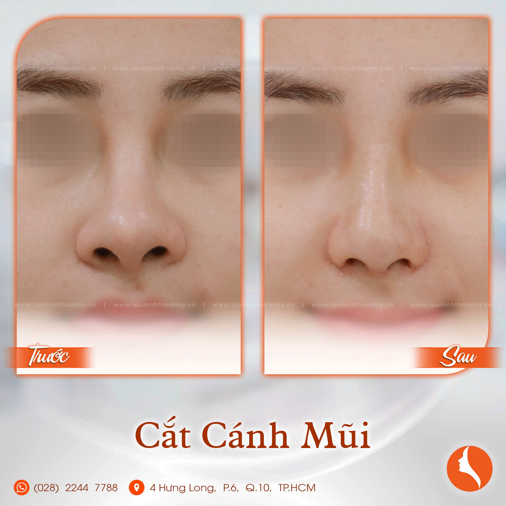 Mũi to bẩm sinh và các phương pháp thu gọn mũi - PK TsBs Nguyễn Thành Nhân
