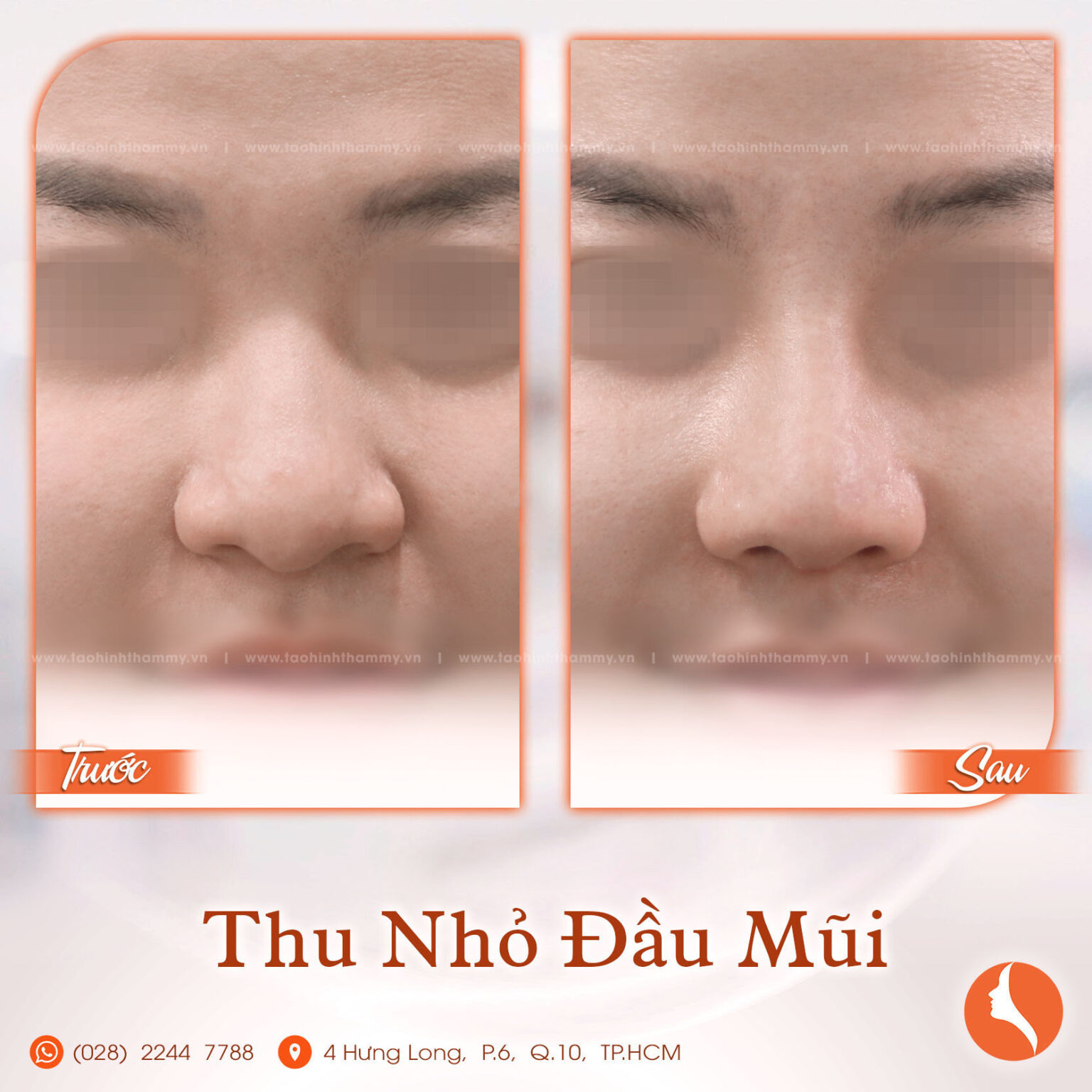 Mũi to bẩm sinh và các phương pháp thu gọn mũi - PK TsBs Nguyễn Thành Nhân