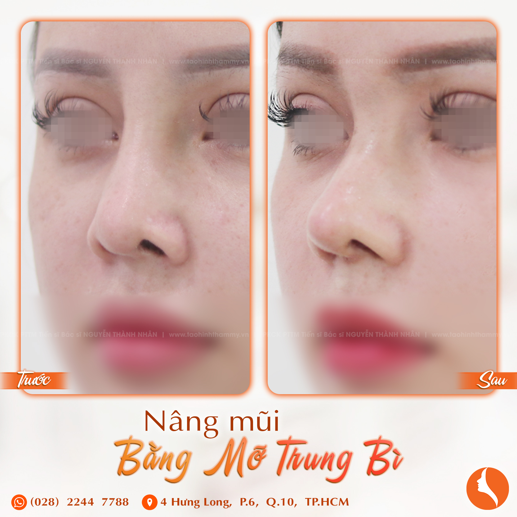 Nâng mũi bằng mỡ trung bì - Tiến sĩ Bác sĩ Nhân